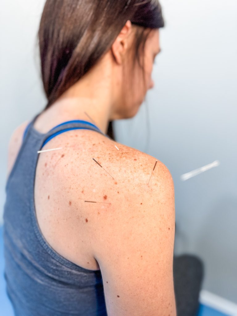 Acupuncture For Shoulder Pain | Clinically Proven Relief