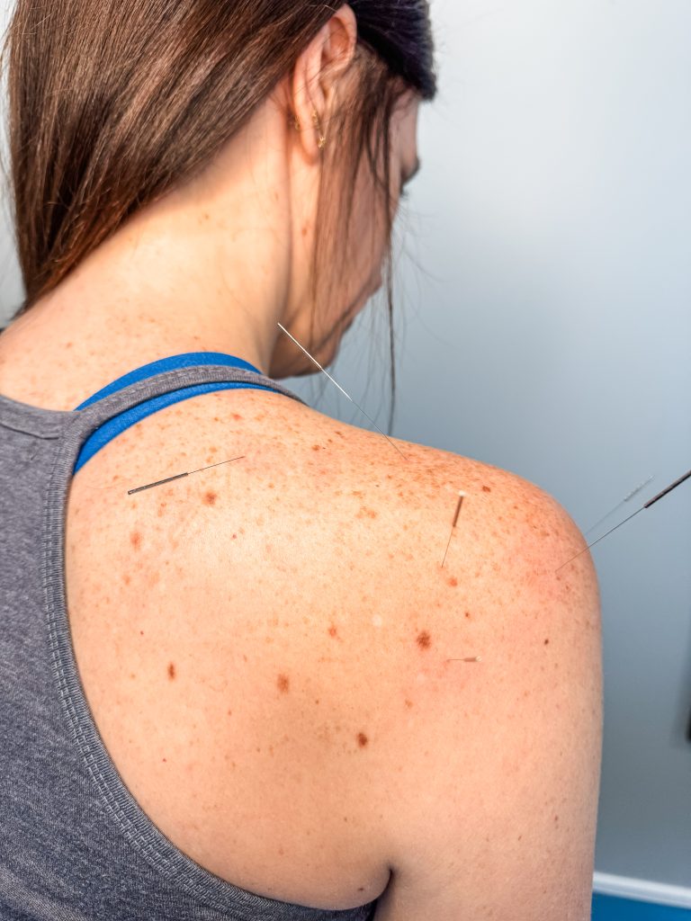Acupuncture For Shoulder Pain | Clinically Proven Relief