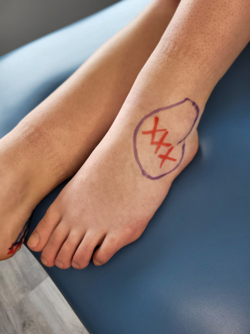 Sinus Tarsi Syndrome Treatment Oakville | Book Now