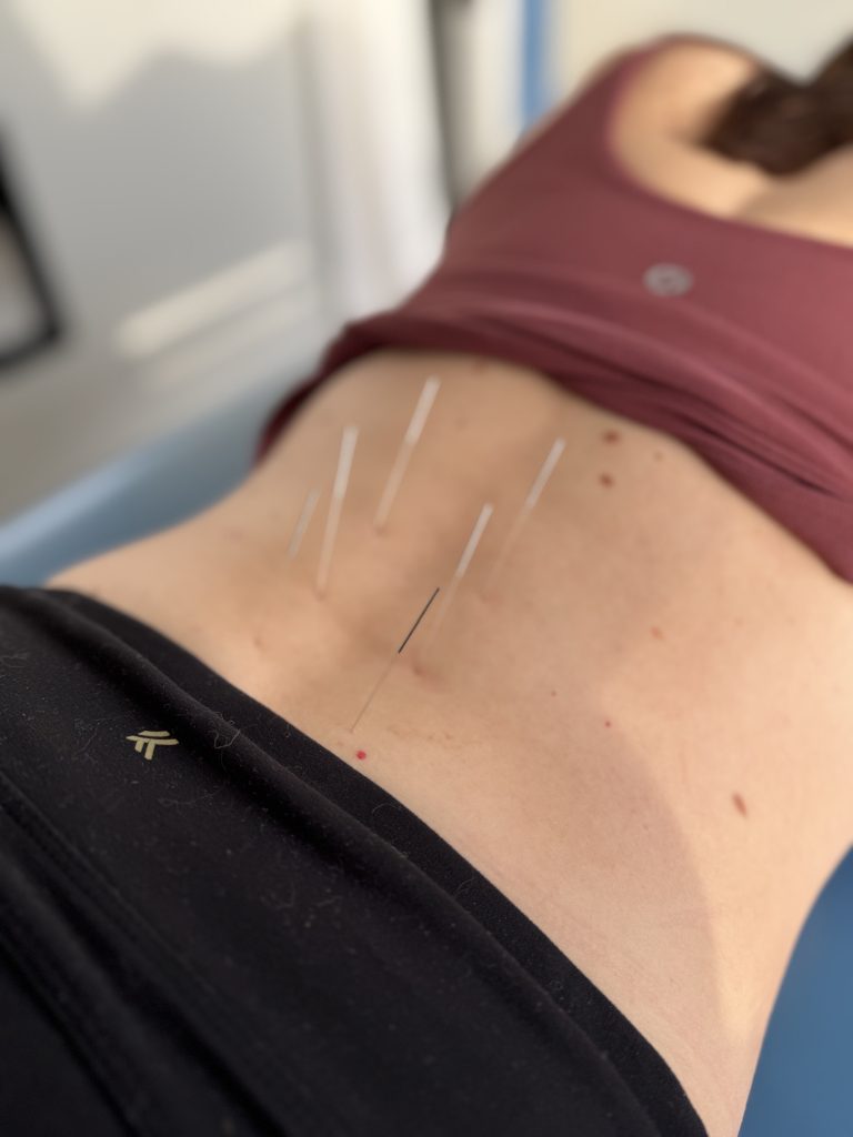 Acupuncture For Low Back Pain Oakville - Dr. Jenn Garven