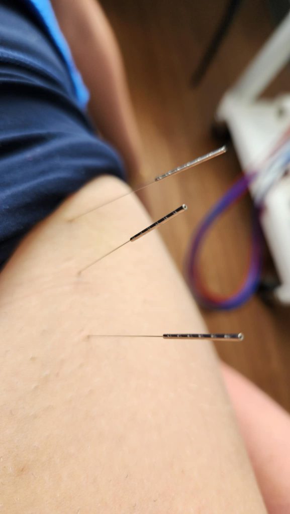 Anterior Pelvic Tilt Treatment Oakville | Fast Relief Now